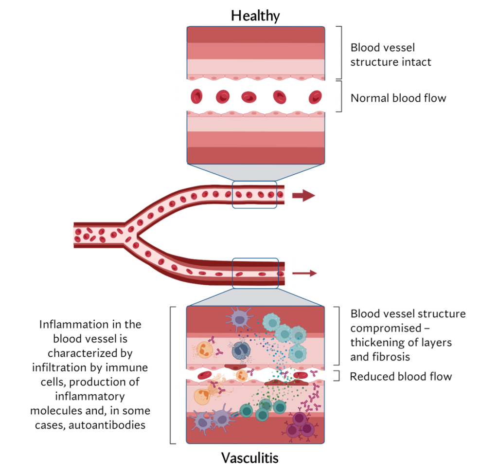 Vasculitis-image : Johns Hopkins Vasculitis Center