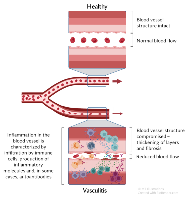What is Vasculitis? : Johns Hopkins Vasculitis Center