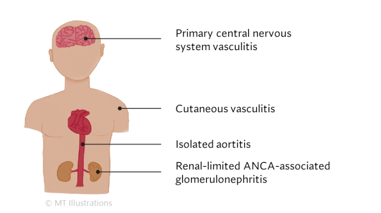 Types of Vasculitis : Johns Hopkins Vasculitis Center