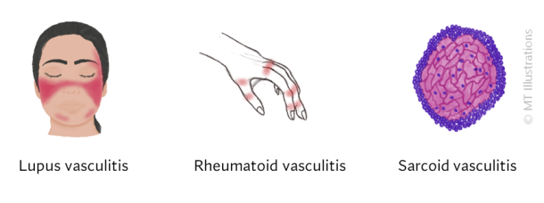 Types of Vasculitis : Johns Hopkins Vasculitis Center